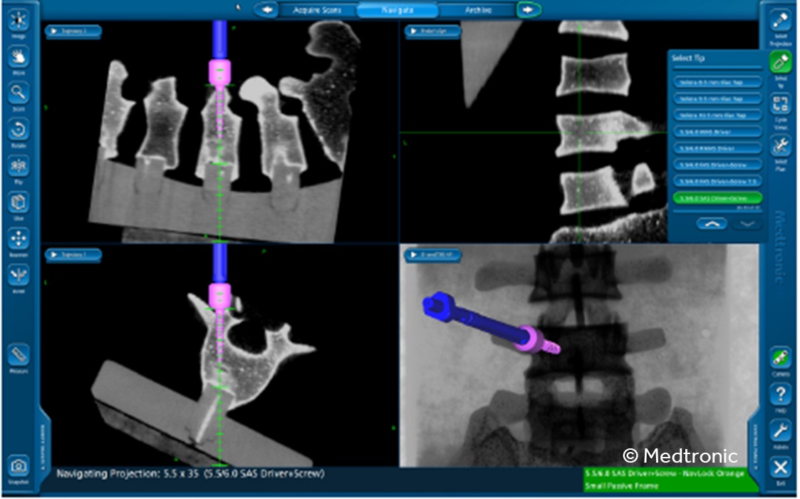 ナビゲーションシステム StealthStation S7【臨床工学科】 | おおさかグローバル整形外科病院 | 大阪市城東区 | 脊椎、人工 ...