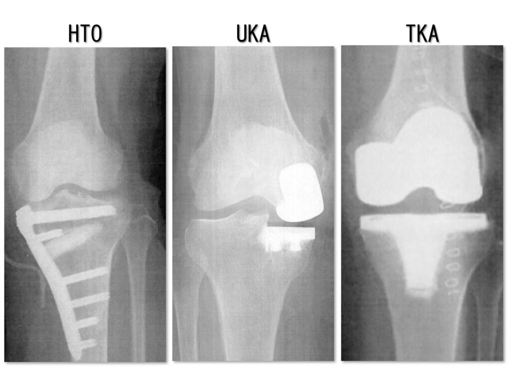 高位脛骨骨切り術（HTO) | おおさかグローバル整形外科病院 | 大阪市城東区